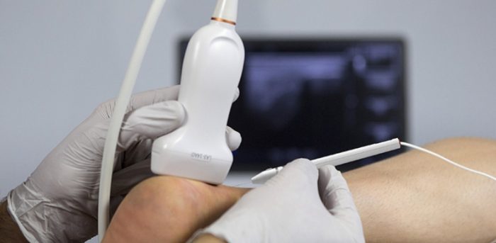 Percutane Electrolyse | Fysiotherapie Ommedijk